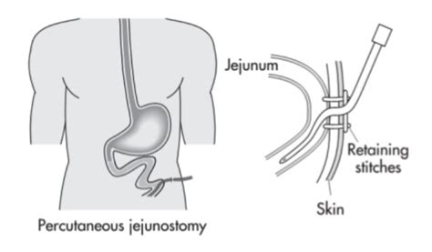 J Tube Placement A Brief History Of Ureteral Stents
