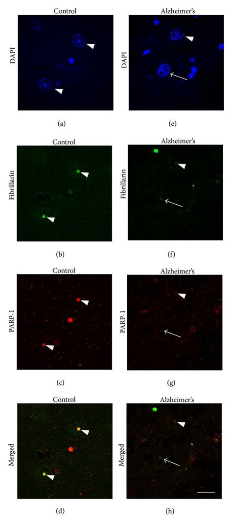 Nucleolar Proteins In Hippocampal Pyramidal Cells Are Altered In Ad