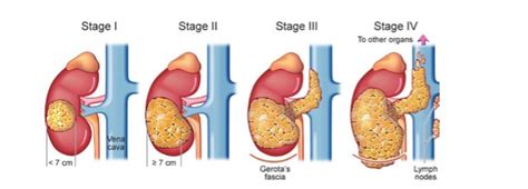 Бөөрний хортой хавдрыг хэрхэн эмчлэх вэ