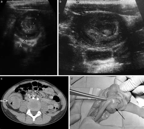 Intussusception Target Sign