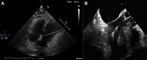 A Transthoracic Echocardiogram Showing The Pacing Lead In The Left