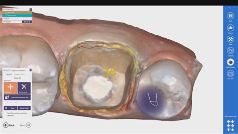 Quick Design In Exocad 2 Cad