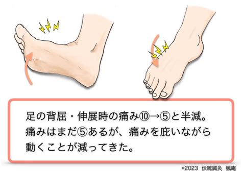 【治療日誌】モートン病 No2｜伝統鍼灸 楓庵