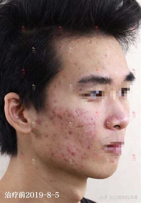 男生长痘多年，有痘印痘坑，有什么解决办法？ 知乎