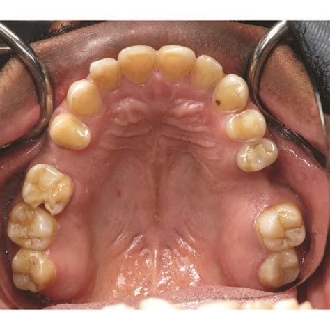 Protrusive Interference And Lack Of Anterior Guidance Download Scientific Diagram
