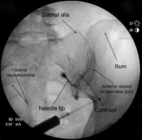 Hip Pain Management Pain Care India
