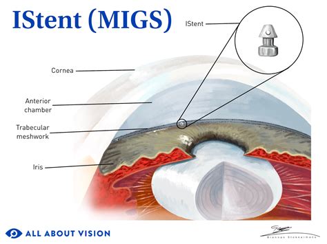Trabecular Meshwork Key Role In Eye Fluid Drainage