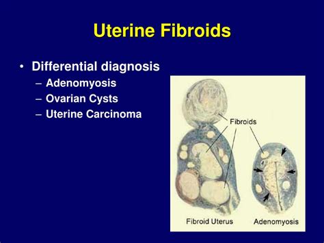 Ppt Uterine Fibroid Embolization Powerpoint Presentation Free Download Id 373183