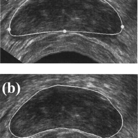 Operation Of The Prostate Segmentation Algorithm A Initial Outline