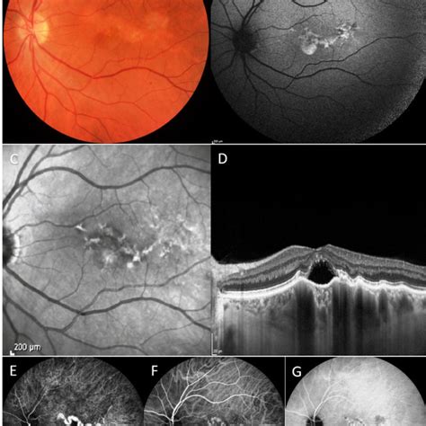 Profile Of Foveal Subretinal Fluid In 54 Eyes With Nonresolving CSCR Download Scientific