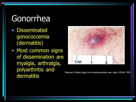 Sexually Transmitted Diseases Ppt Video Online Download