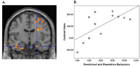 Figure 5 From Abnormalities Of Intrinsic Functional Connectivity In Autism Spectrum Disorders