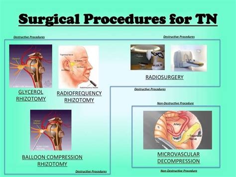Surgical Procedures Used To Treat Trigeminal Neuralgia Trigeminal Neuralgia Neuralgia Radio