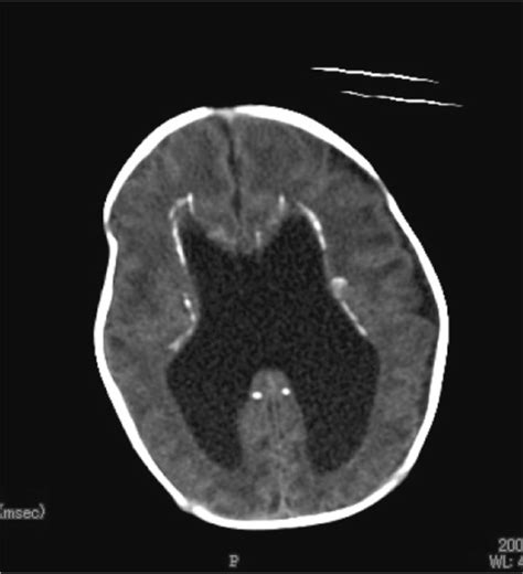 Brain Ct As A Neonate Symmetrical Calcifications In The Download