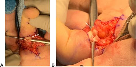 Surgical Photographs Of The Ring Finger Flexor Tendons In A
