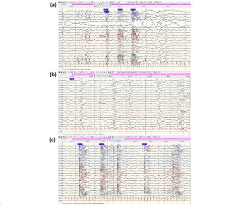 Eeg Of The Patient At Different Ages A 5 Yo During Drowsiness Download Scientific Diagram