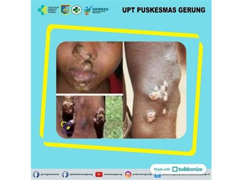 Puskesmas Gunungsari Waspada Penyakit Frambusia