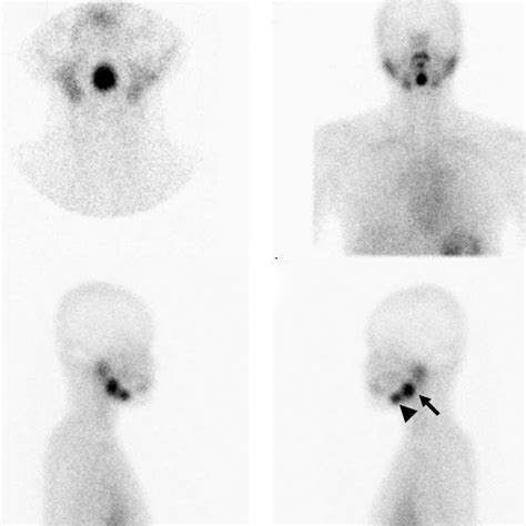 Endoscopic View Of The Lingual Thyroid Tissue At The Tongue Base Download Scientific Diagram