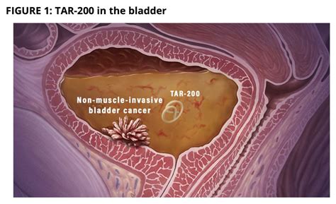Eau 2024 Results From Sunrise 1 In Patients With Bcg Unresponsive High Risk Non Muscle Invasive
