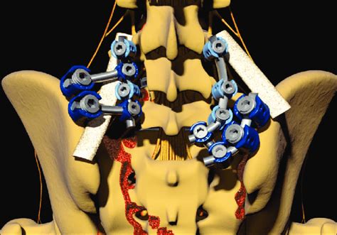 Pa Illustration Of Bilateral Pelvic Fixation Construct After A