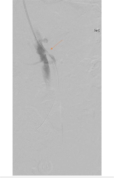 Mesenteric Angiogram Demonstrating Stenosis Of The Superior Mesenteric Download Scientific