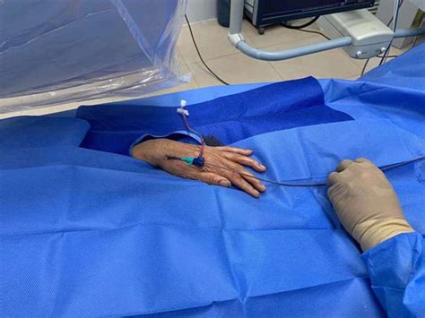 The 6 French Radial Artery Sheath Is Inserted Through The Distal Radial