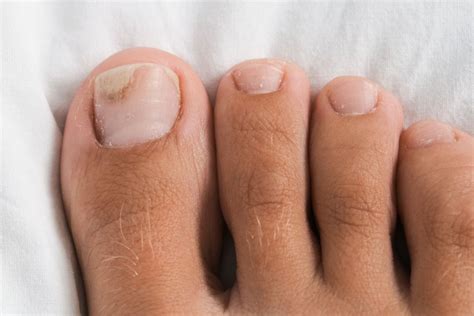 Early Stage Toenail Fungus Symptoms And Treatment