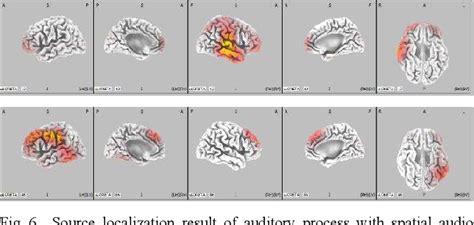 Figure 6 From Quantitative Eeg Analysis Based On Psd And Eloreta Source Localization Approach In