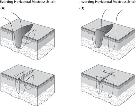 Figure 1 From The Inverting Horizontal Mattress Suture Applications In Dermatologic Surgery