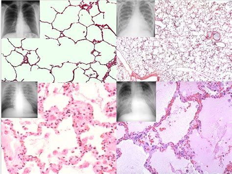 Pulmonary Edema Histology Com702 1 04 