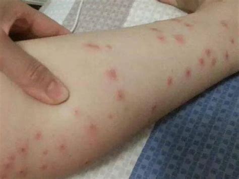 夏季蠓虫活跃 防范正当时