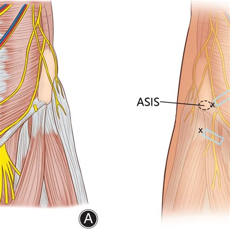 The Location Of The Iliohypogastric Nerve Ihn The Ilioinguinal Nerve Download Scientific