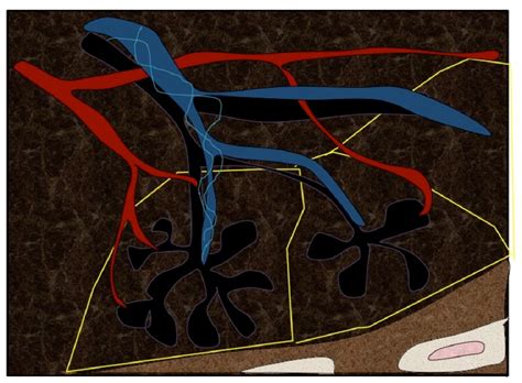 Table 1 From Breaking Bud A New Twist To Tree In Bud Pattern In Bronchiolitis Semantic Scholar