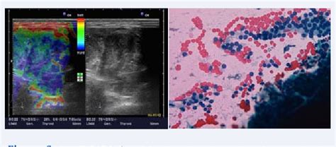 Table 1 From Combined Thyroid Imaging Report And Data System Ti Rads And Ultrasound Guided Fine