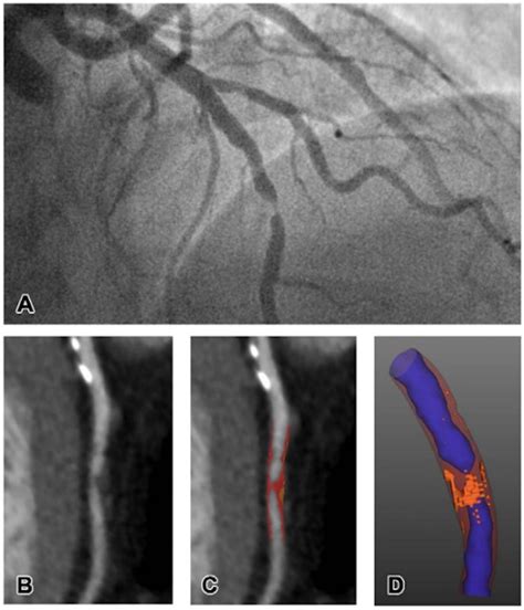 Ctca Can Assist In Determining Type Of Heart Attack