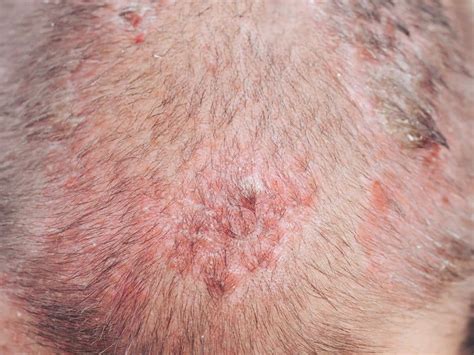 Scalp Pimples Causes And Treatment