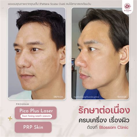 โปรแกรม Pico Laser คืออะไร ทำไมถึงยอดนิยม ลดกระ ฝ้า