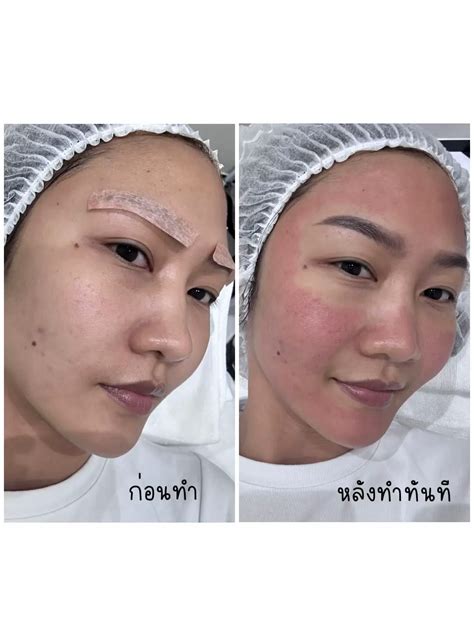 Pico Laser ครั้งที่ 3 แล้ว 😎 ดูแลผิวยังไงบ้าง แกลเลอรีที่โพสต์โดย Aomiiz Aom Lemon8