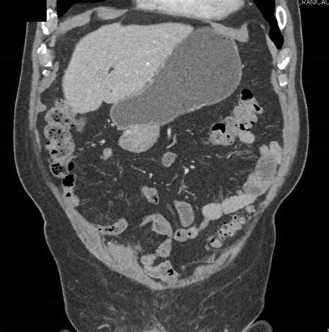 Exophytic Gastric Gist Tumor Stomach Case Studies Ctisus Ct Scanning