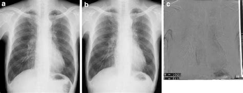 A Previous Chest Radiograph B Current Radiograph And C Temporal Download Scientific