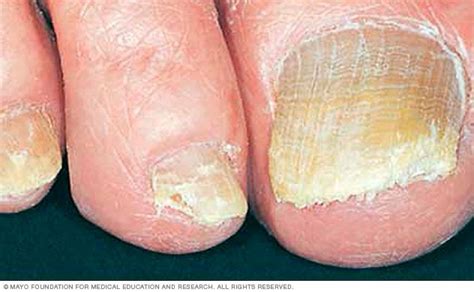 Nail Fungus Disease Reference Guide