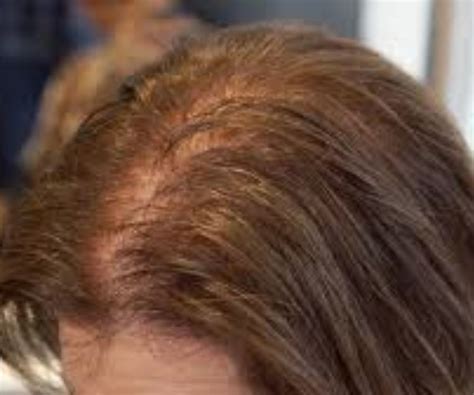 The Best Hairstyles For Balding Crown Female Your Holiday Partner For