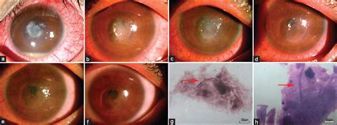 Drlestari Rahmah Mkt Keratitis