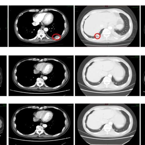 Ct Scans For One Patient Achieving Pr In Dose Expansion Cohort Before Download Scientific