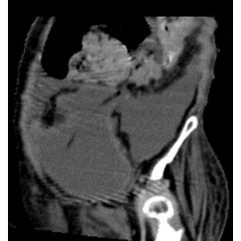 7 Mm Obstructing Left Puj Calculus Download Scientific Diagram