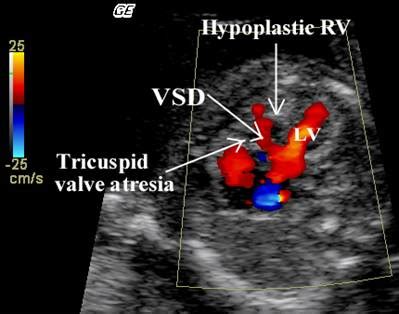 Ultrasound Criteria Of Tricuspid Atresia