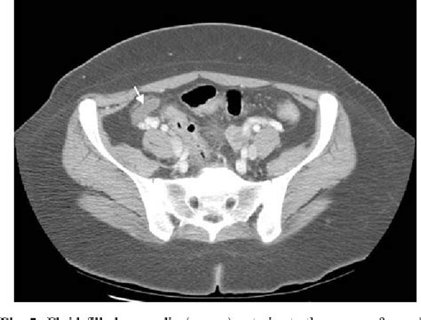 How Big Is A Normal Appendix At Alexis Owen Blog
