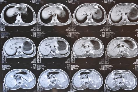 Mrcp Considerations As An Alternative For Ercp