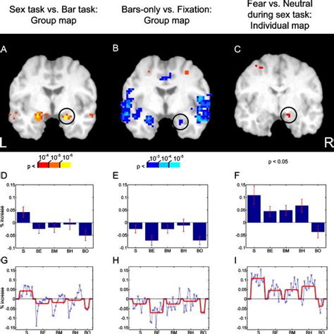 A Group Map Of The Contrast Of The Sex Task Vs Bar Orientation Task Download Scientific