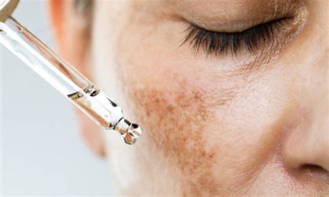 Treating Hyperpigmentation Pure Dermatology